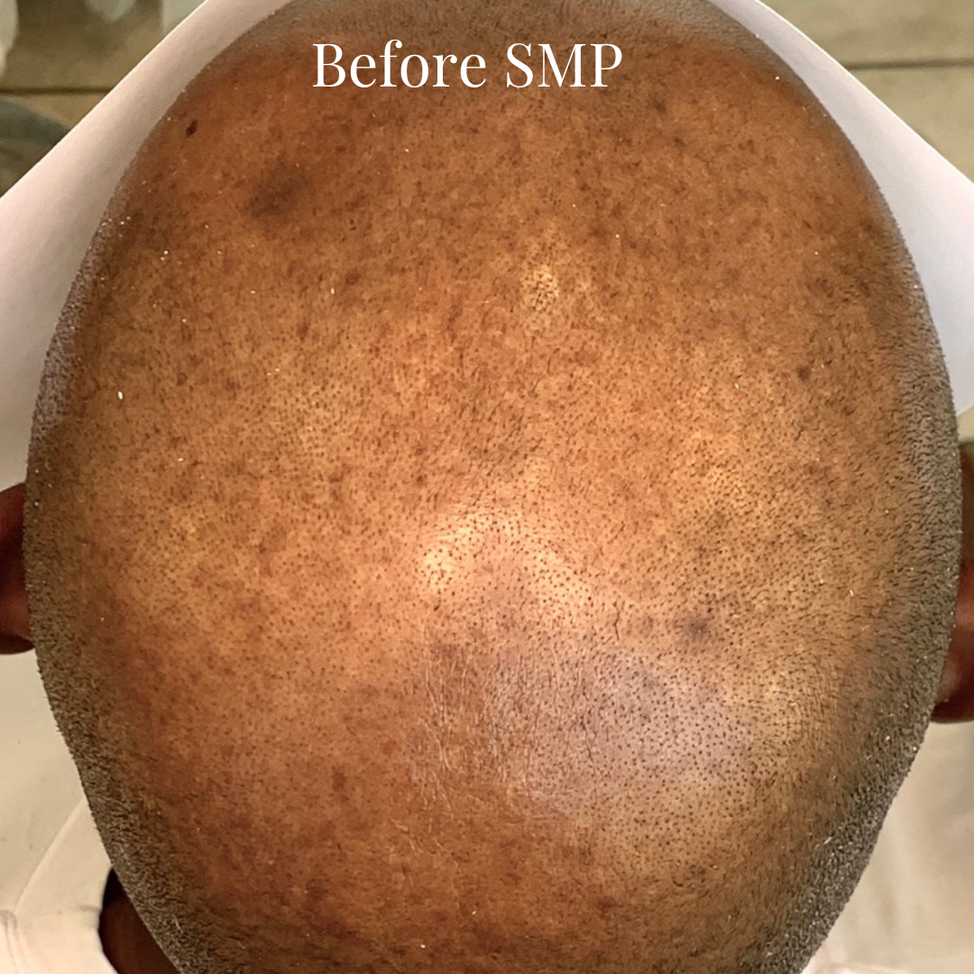 Scalp Micro Pigmentation - Scalp Tattooing